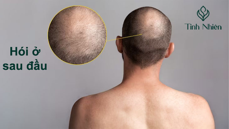 Hói ở sau đầu: Nguyên nhân, dấu hiệu và cách điều trị